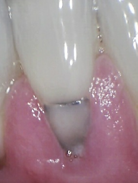 Blood thinners and dental treatment - Bassam Michiel, D.D.S.